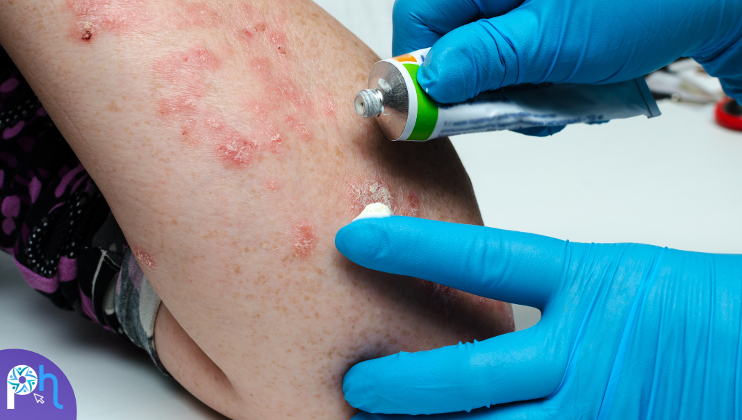Estos son los tratamientos más actualizados para la psoriasis - Phlatames