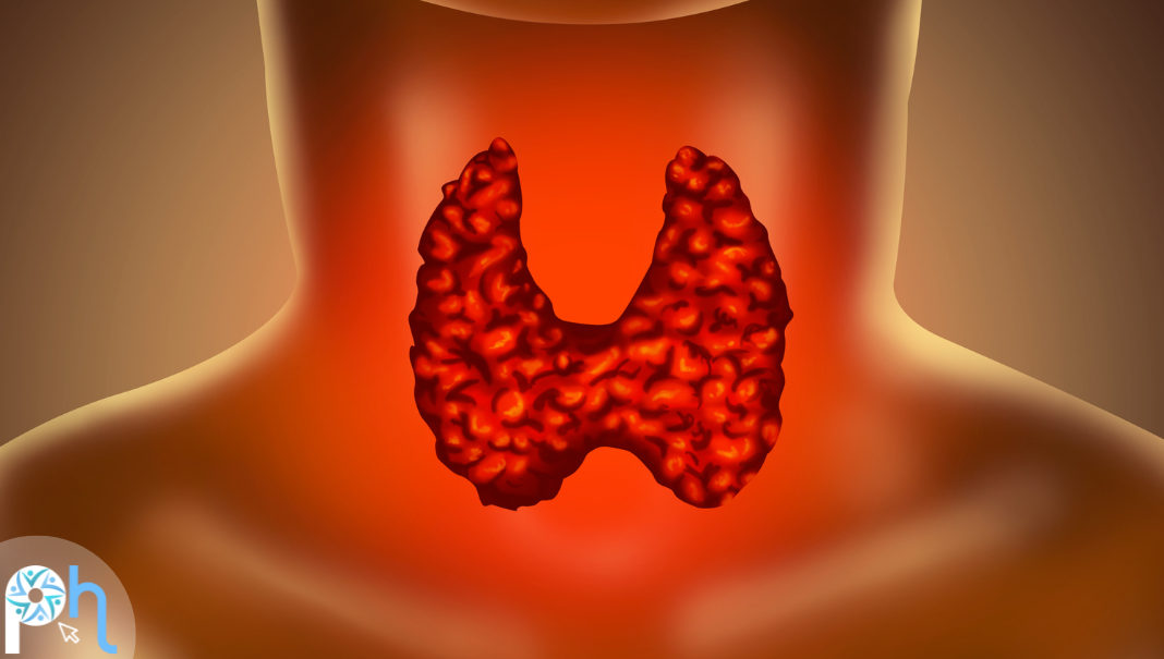 Cómo se origina el cáncer en la tiroides - Phlatames