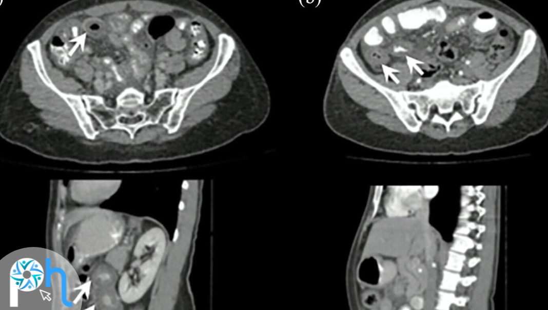 Lupus Enteritis: diagnóstico diferencial que debe ser considerado en ...