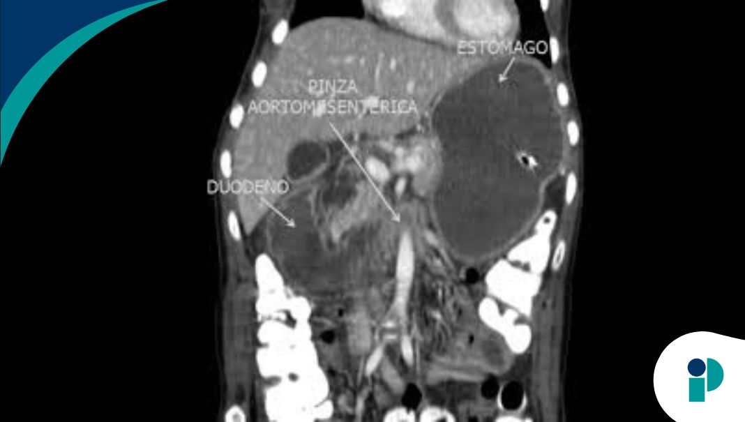 Síndrome de arteria mesentérica superior y pancreatitis aguda: caso ...