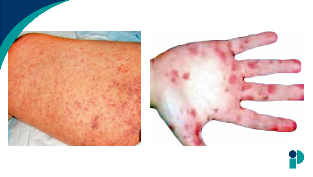 La fiebre manchada por Rickettsia rickettsii: ¿Una enfermedad tropical ...