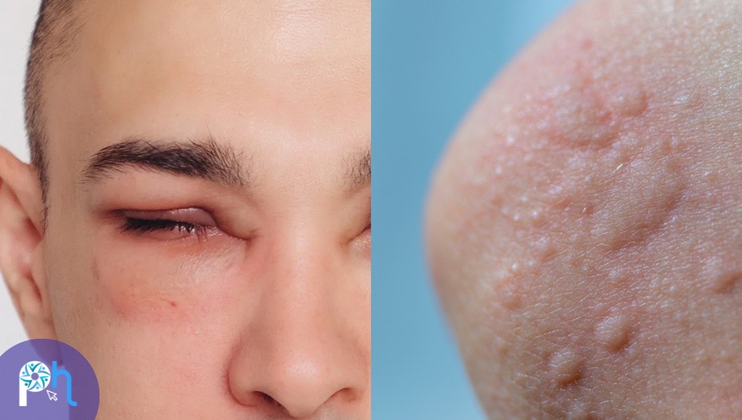 Fisiopatología y manejo de la urticaria y angioedema - Phlatames