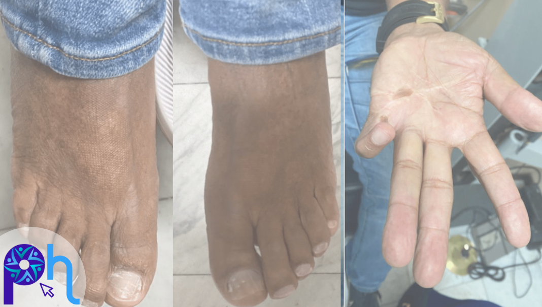 Enfermedad de Refsum del Adulto (ARD): conozca el primer caso ...