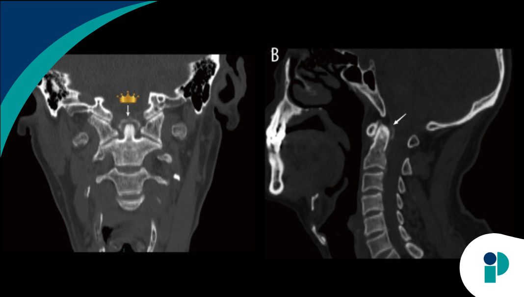 Dolor de cuello agudo por síndrome de Crowned Dens: informe de caso ...