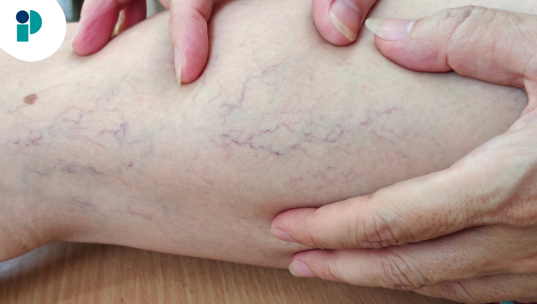 Várices en las piernas: cuándo preocuparse y cómo tratarlas - Phlatames