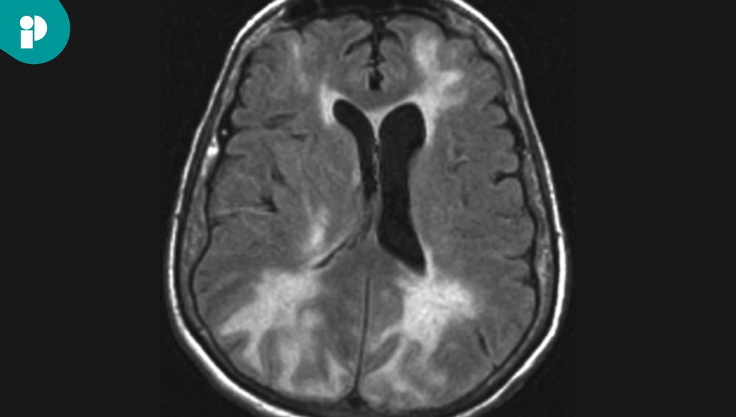 Estudio del RCM identifica riesgos del Síndrome de Encefalopatía ...