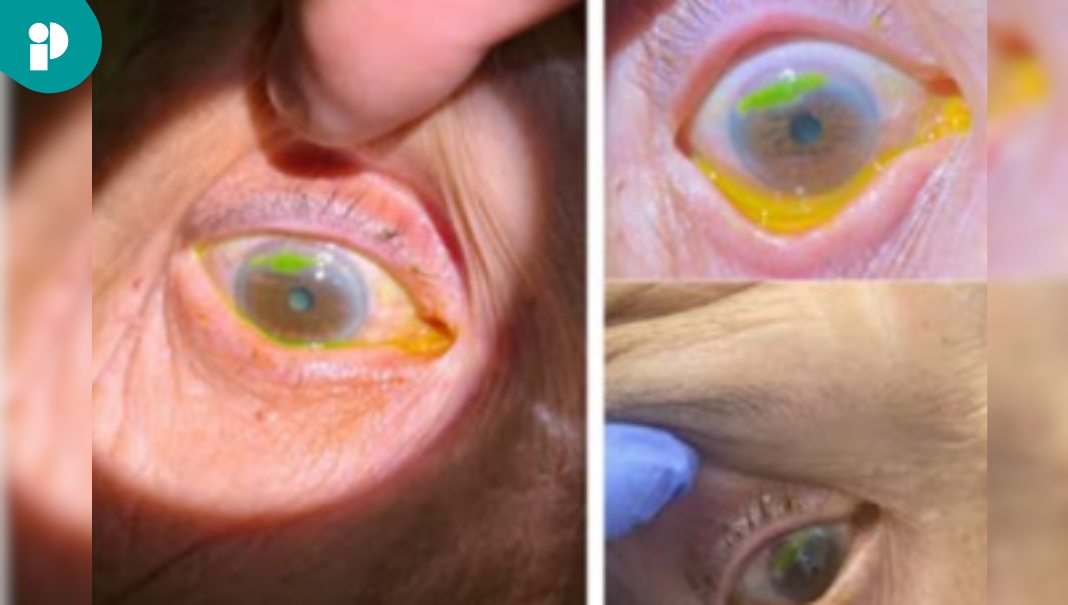 Queratitis ulcerativa periférica como complicación de la artritis reumatoide - Phlatames