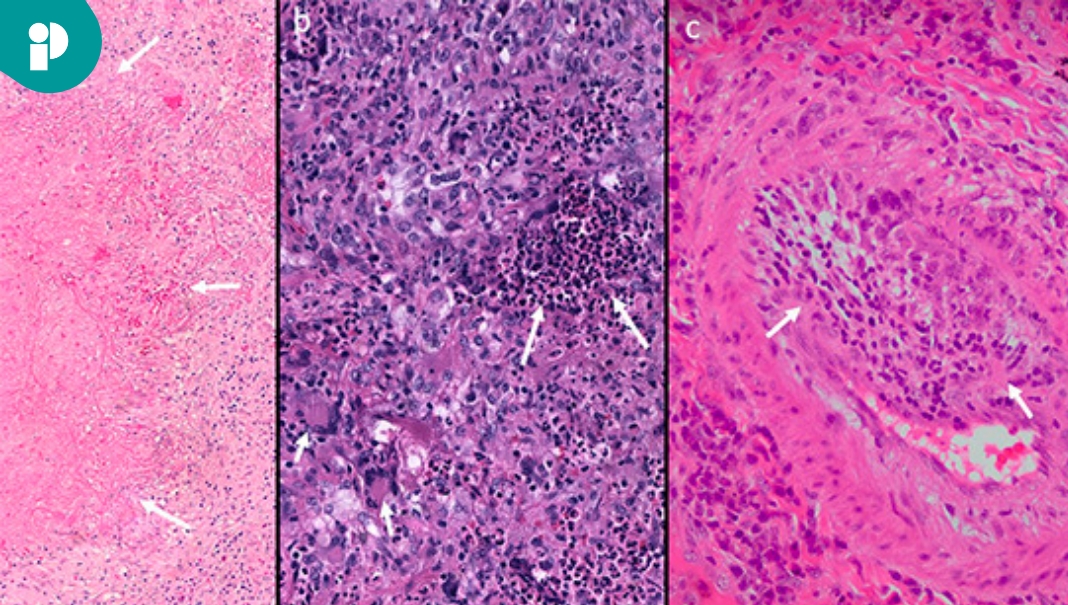 Inflamación gingival como manifestación de la granulomatosis con ...