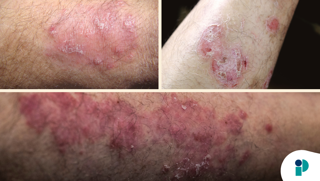 Prurito crónico: Nuevas alternativas terapéuticas para una condición ...