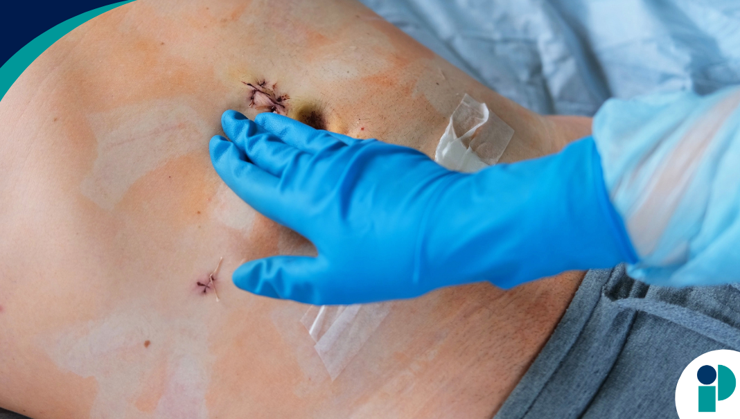 Apendicectomía Provoca Hemorragia Mediastínica En Paciente Con
