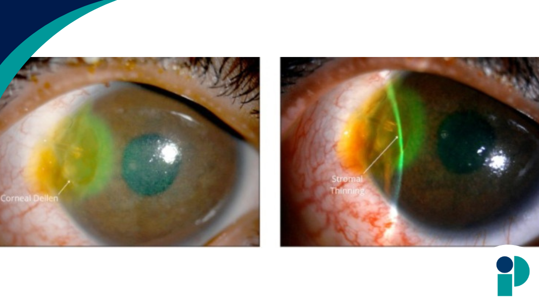 Inusual caso de dellen corneal tras cirugía con microdispositivo para ...