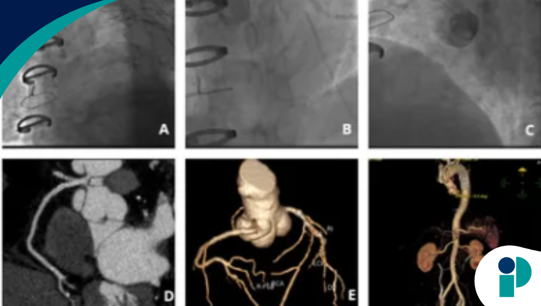 Infarto agudo de miocardio tras cirugía aórtica revela compleja ...